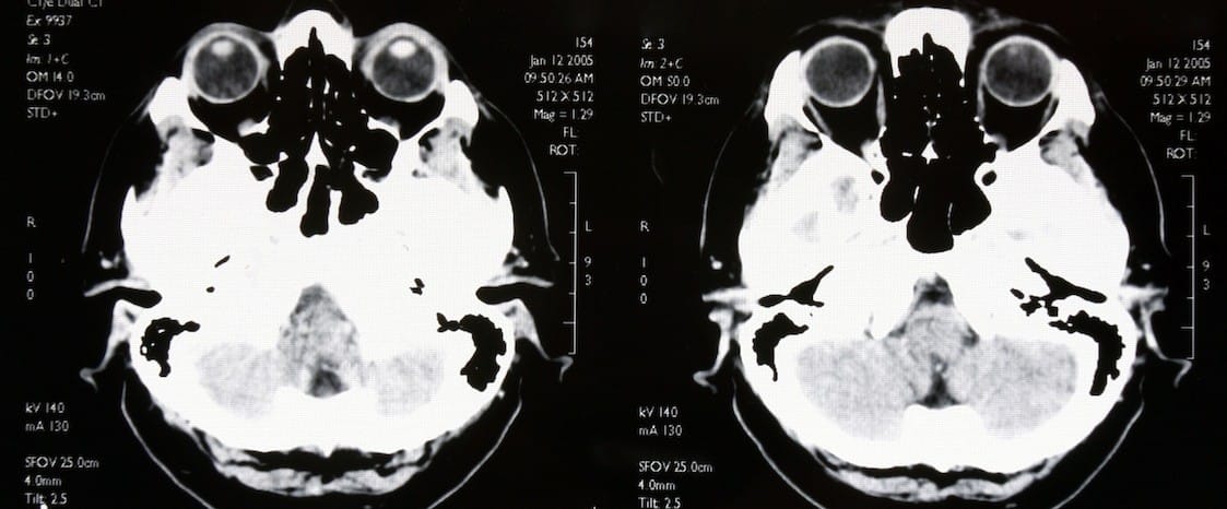 Brain Imaging Sheds New Light on Bipolar Disorder in Children ...