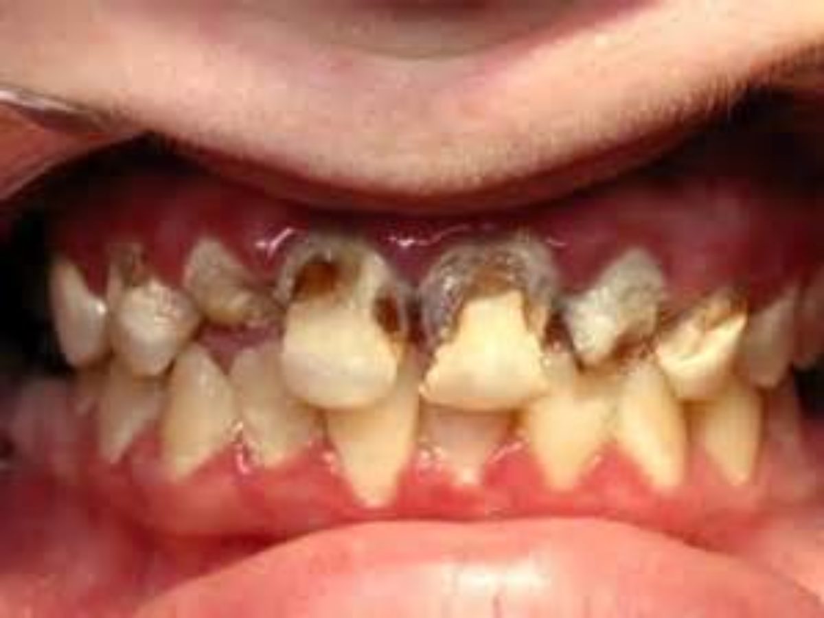 Heroin Addict Teeth What Is Meth Mouth & What Does It Look Like?