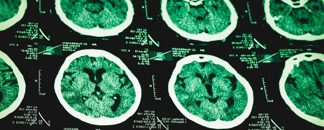 How Does Meth Damage the Brain? - Promises Behavioral Health